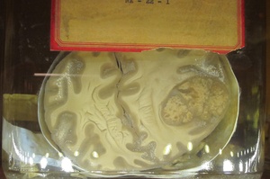 Cushing Brain Collection